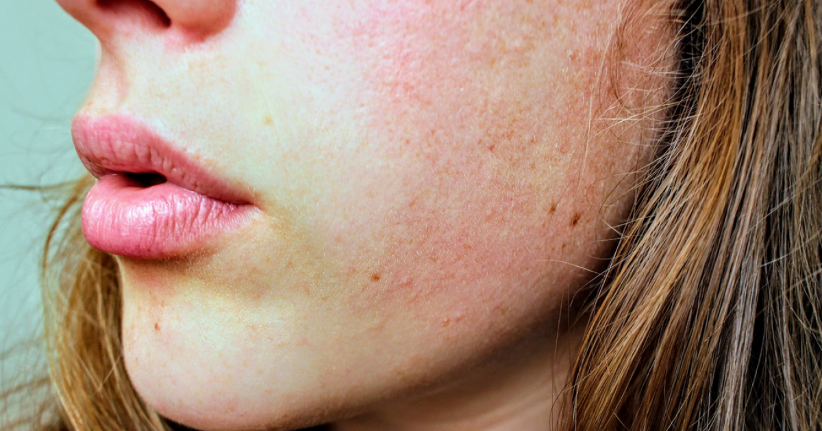 Kako se osloboditi bubuljica od znoja? | Mogu Ja To Sama - Svaki ženski ...